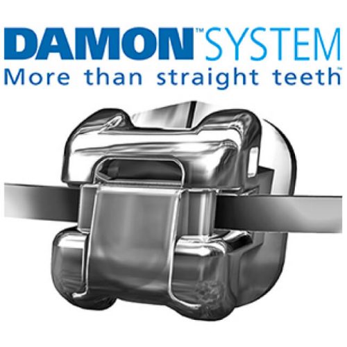 Damon Braces | Paciorek Orthodontics | Camillus, NY